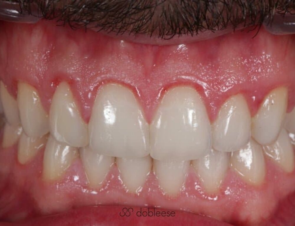 Paladar ojival: consecuencias y tratamiento para agrandar el paladar ...